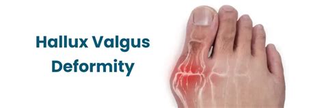 Hallux Valgus Causes Symptoms And Prevention