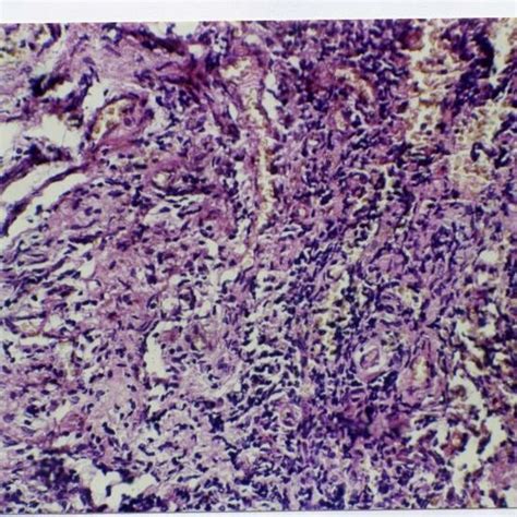 Pdf Recurrent Granular Myringitis Pathogenesis And Treatment