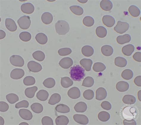 Giant Platelet Hematology