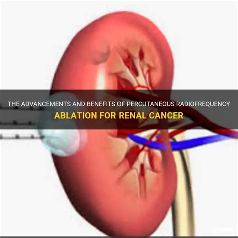 The Advancements And Benefits Of Percutaneous Radiofrequency Ablation For Renal Cancer Medshun
