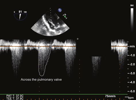 Gradient Across The Pulmonary Valve Note The Characteristic Early