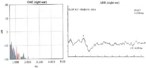 The Otoacoustic Emission Test And Auditory Brainstem Response Test