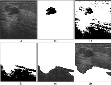 [pdf] Automatic Lesion Detection In Ultrasonic Images Semantic Scholar