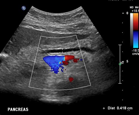 Uncinate Process Ultrasound Jcdr 15 Td01 G002