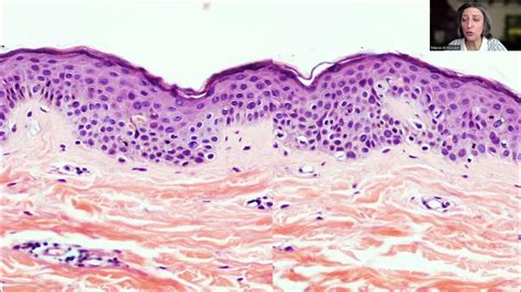 Tip 32chemotherapy Induced Skin Rash Chemo Rash” Youtube
