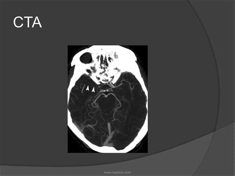 C T Imaging Of Acute Stroke Ppt Free Download