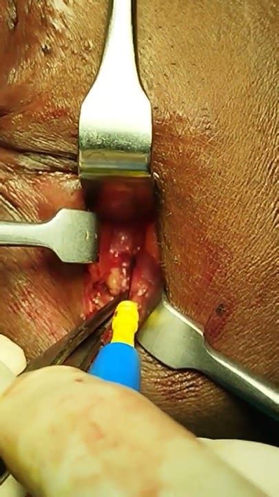 Intersphincteric Space Fistulous Tract Dissection Patanjali Yogpeeth Dr