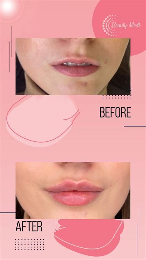 ბუნებრივი შემავსებელი ფილერი