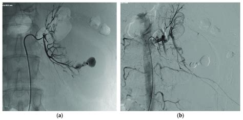 Endovascular Glue Selective Embolization Of An Faa After Left Partial