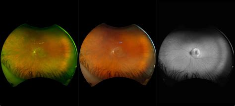 Subretinal Hemorrhage