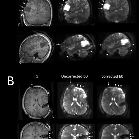 Two Case Examples Illustrating The Quality Of Dwi Epi Distortion Download Scientific Diagram