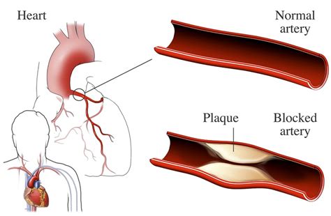 Coronary Artery Disease