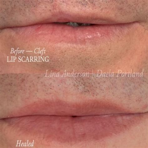 How To Choose The Best Permanent Lip Color For You Daela
