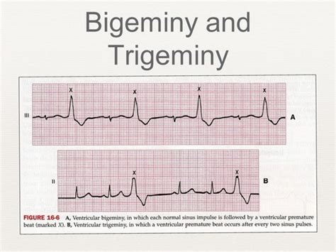 Premature Ventricular Contractions Trigeminy
