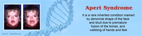 Apert Syndrome Causes Symptoms Diagnosis And Treatment