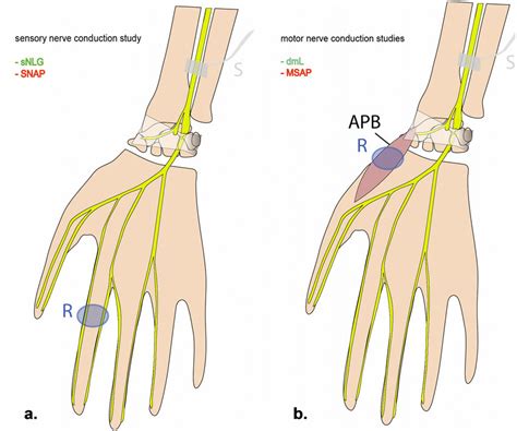 Conduction Block Sensory Nerve At Sara Mccall Blog