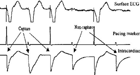 Figure 3 From Effect Of Pacemaker Output Coupling Capacitor On Intracardiac Evoked Response