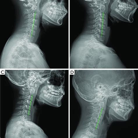 Global Spinal Sagittal Alignment Parameters Sva C7 Tilt Tpa T1spi Download Scientific Diagram