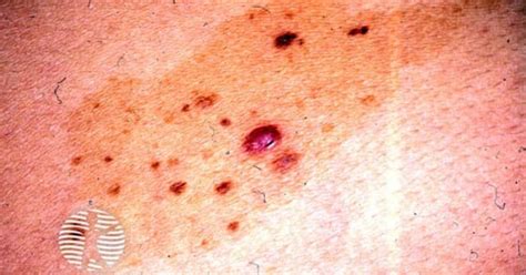 Congenital Naevus Image