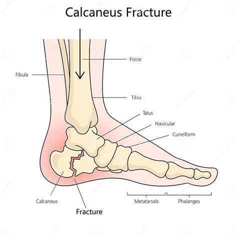 Calcaneus Fracture Diagram Medical Science Stock Illustration