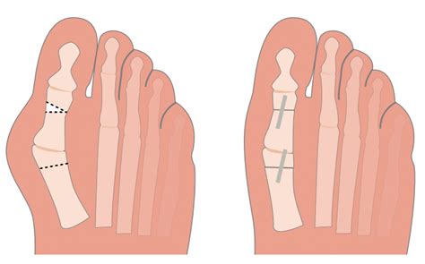 Hallux Valgus Définition évolution Et Opération