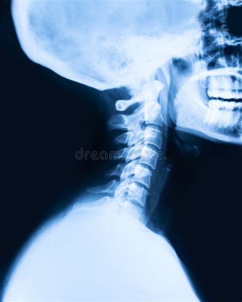 Cervical Spine X Ray Views Kotitimes
