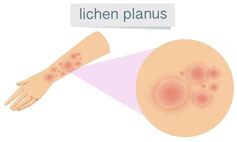 Lichen Planus Know Lichen Planus Treatment Symptoms Causes And Types
