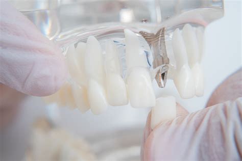 치열 교정 의사는 그의 손에 임 플 란 트와 치아의 모델을 보유 하 고 치아를 삽입 하는 방법을 보여줍니다 닫습니다 매크로 치아 임플란트에 대한 스톡 사진 및 기타 이미지