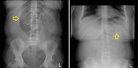 Abdominal X Ray Showing Dilated Proximal Bowel Loops With Multiple Download Scientific Diagram