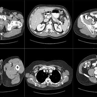 Unified Supervised Unsupervised SUPER Learning For X Ray CT Image Reconstruction Request PDF