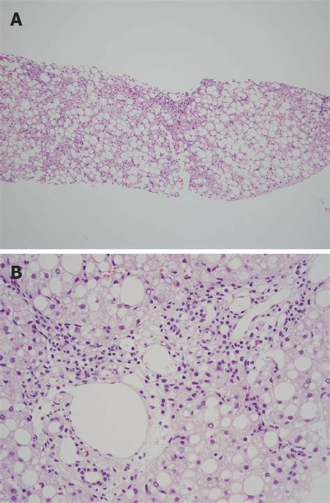 Fatty Liver Histology