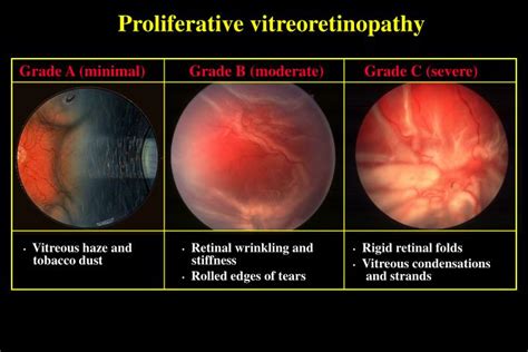 Ppt Pathogenesis And Signs Of Retinal Detachment Rd Powerpoint