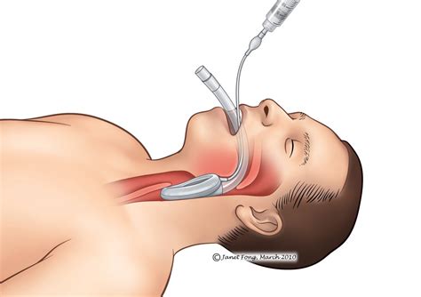 3 The Supraglottic Airway Meme