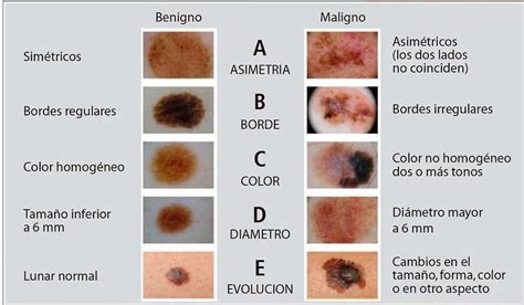 La Sencilla Regla Abcde Para Revisar Tus Lunares Y Detectar El Cáncer