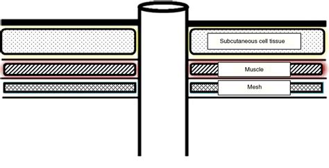Figure 1 From Prevention Of Parastomal Hernia With A Preperitoneal Polypropelene Mesh