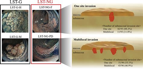 Treatment Policy For Colonic Laterally Spreading Tumors Based On Each Clinicopathologic Feature Treatment Policy For Colonic Laterally Spreading Tumors Based On Each Clinicopathologic Feature