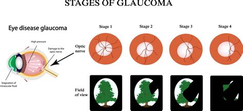 Glaucoma Eye Disease Royalty Free Vector Image
