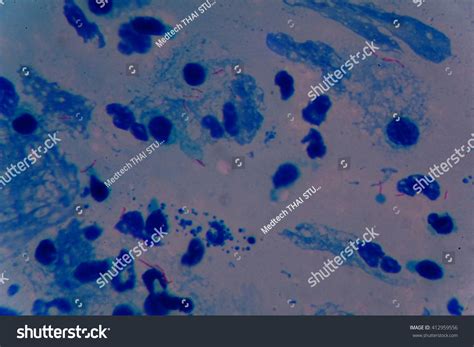 Mycobacterium Tuberculosis Bacteria Under Microscope