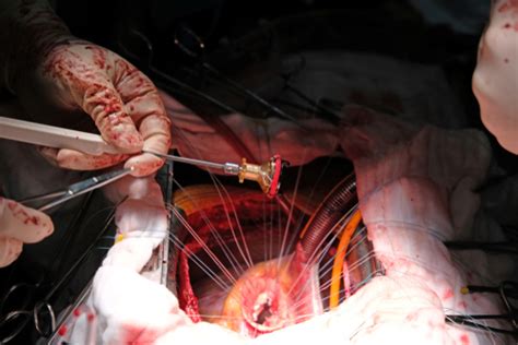 Lava Ecmo To Unload The Left Ventricle The Road Less Traveled Cardio Care Today