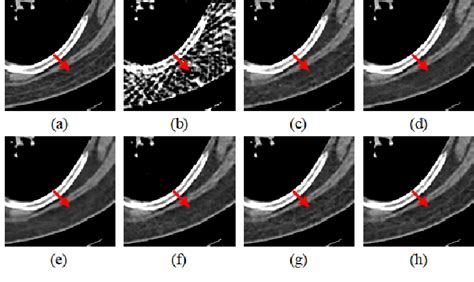 Figure 7 From Convolutional Sparse Coding For Compressed Sensing Ct