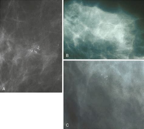 Ductal Carcinoma In Situ Clinical Tree