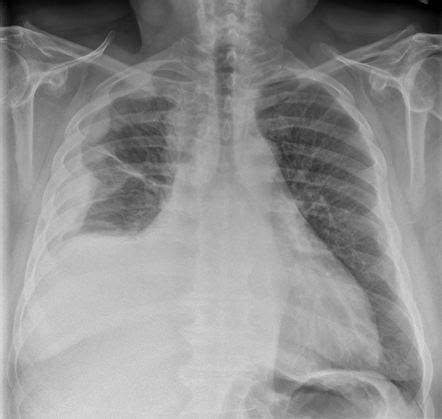 Mesothelioma X Ray