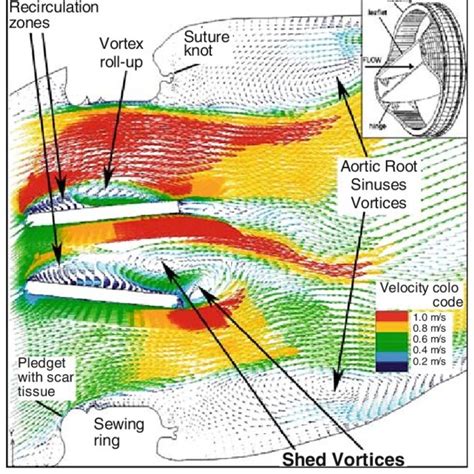 Fsi Simulation Comparing Sjm And Ats Valves Vector Flow Fields And