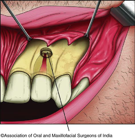 12 2 To 3 Mm Root Tip Resection Download Scientific Diagram