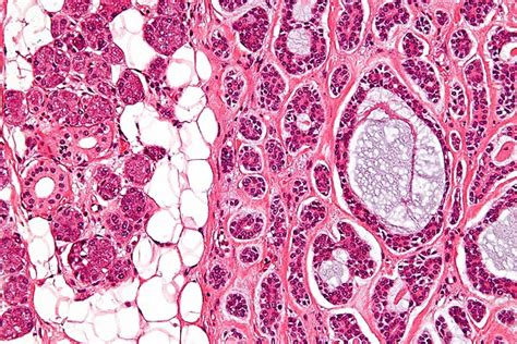 Adenoid Cystic Carcinoma Libre Pathology