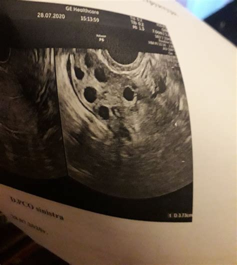 Поликистозни яйчници Тема 5 Проблемно забременяване Страница 24 Мнения от Bg Mamma