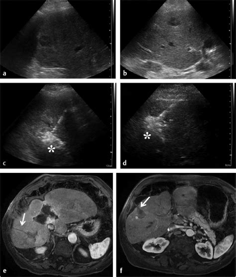 18 Cholangiocarcinoma Radiology Key