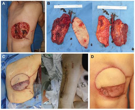 Anterolateral Thigh Chimeric Flap An Alternative Reconstructive Option