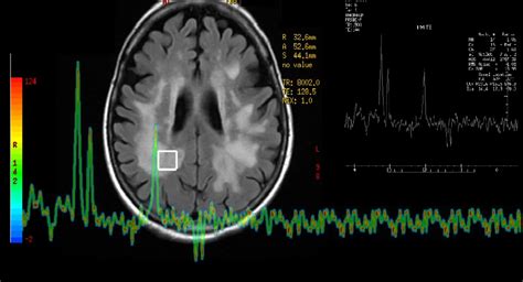 Mri Spectroscopy Brain