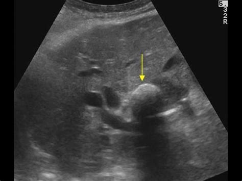 Abdomen And Retroperitoneum 12 Gallbladder And Bile Ducts Case 12